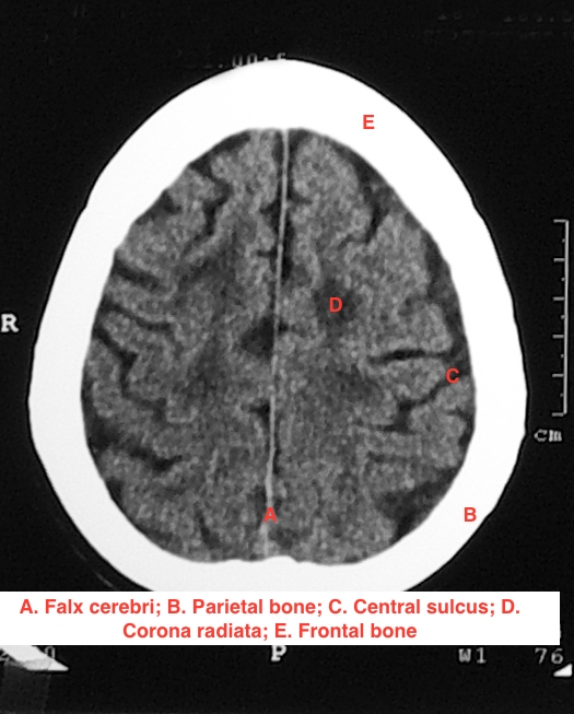 Cross Sectional Images: Head – My CT Registry Review