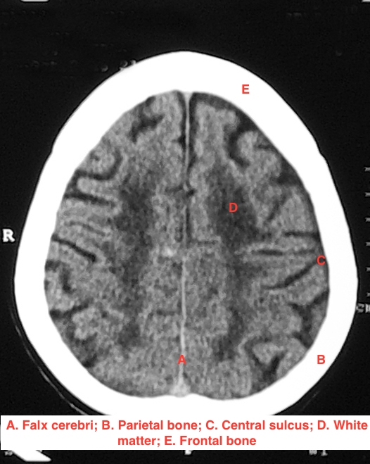 Cross Sectional Images: Head – My CT Registry Review
