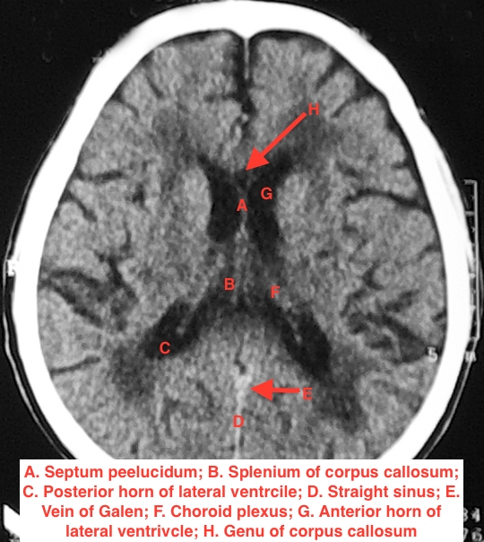 Cross Sectional Images: Head – My CT Registry Review